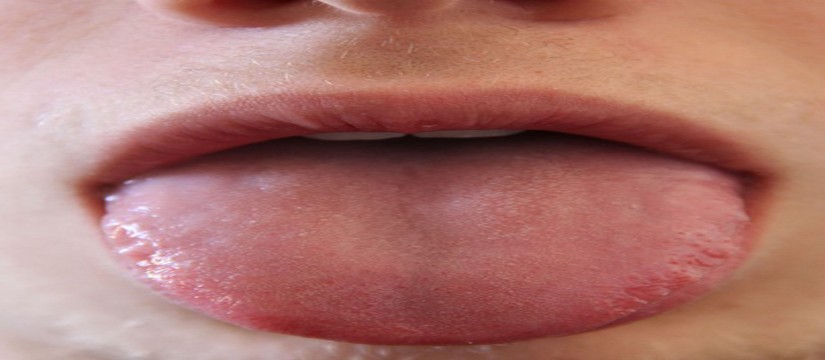 ¿Qué es la glositis? – Sumuela